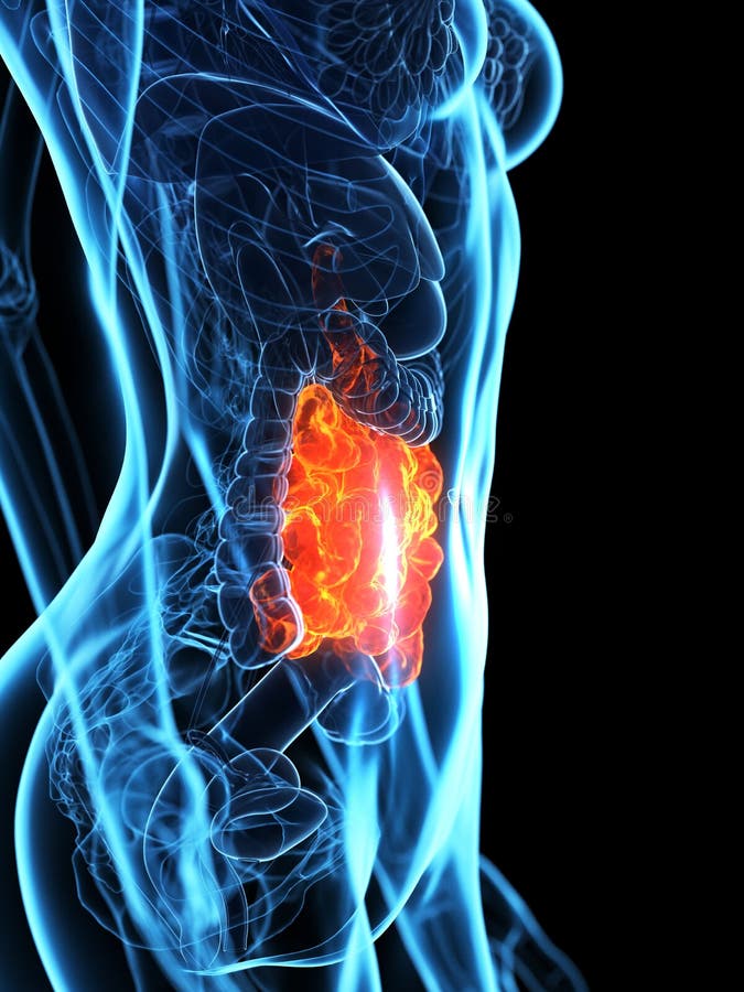 A diseases small intestine stock illustration. Illustration of bowel ...