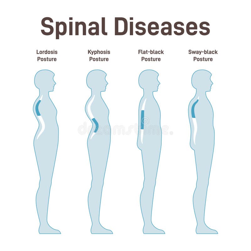 Diseases Of The Spine Scoliosis Lordosis Kyphosis Body Posture Defect