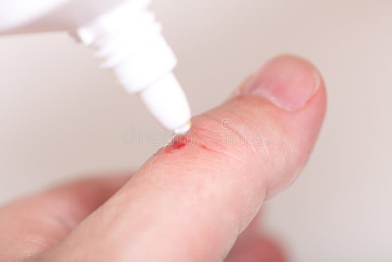 Disinfect the Scratch Alcohol Cuts Hand Health Stock Photo - Image of ...