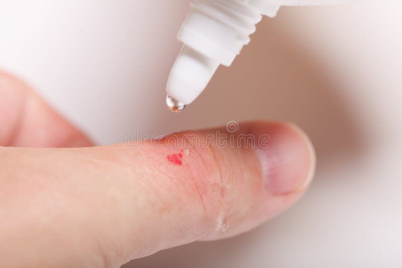 Disinfect the Scratch Alcohol Cuts Hand Health Stock Photo - Image of ...