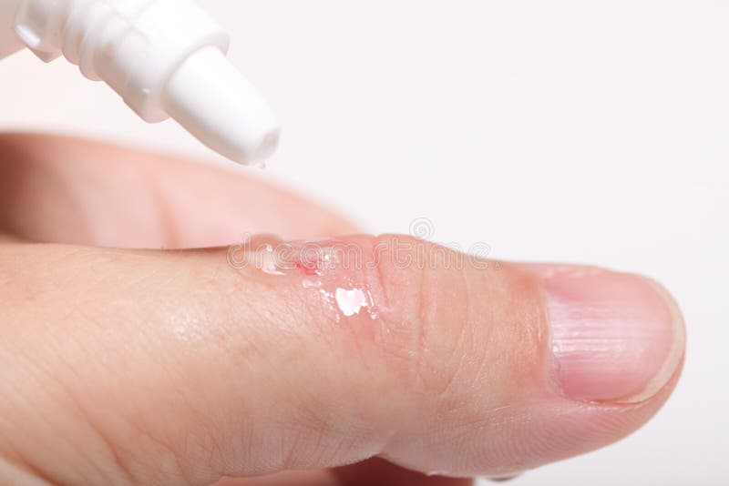 Disinfect the Scratch Alcohol Cuts Hand Health Stock Photo - Image of ...