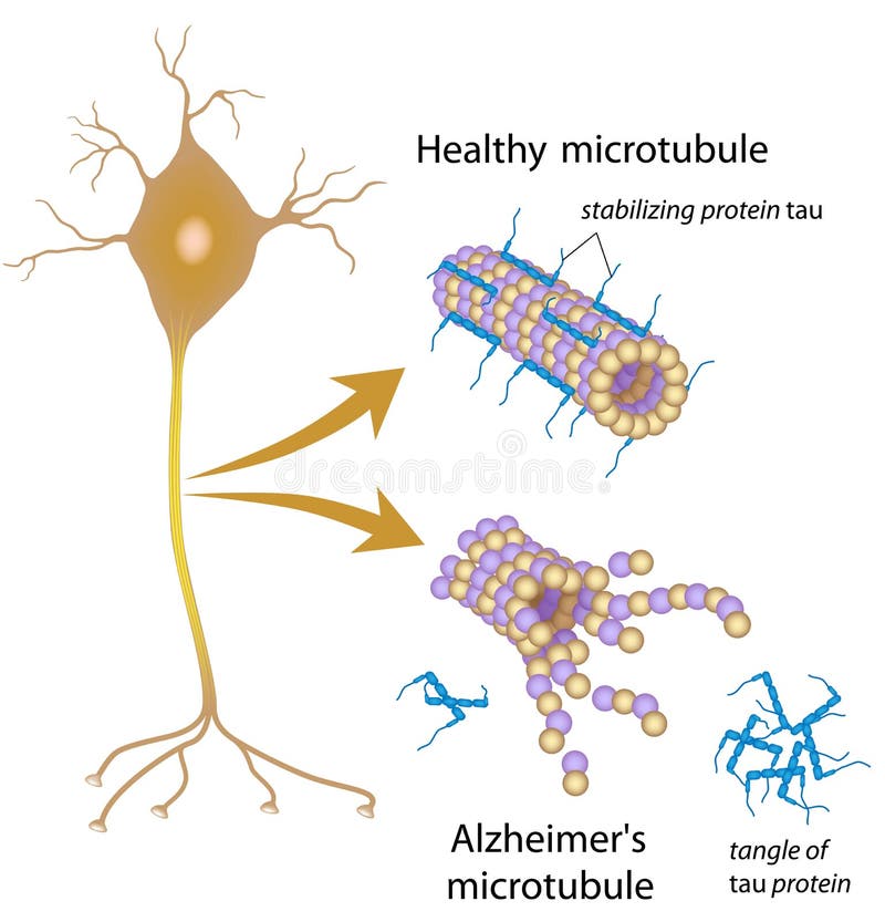 Disintegrating Microtubules in Alzheimer Disease Stock Vector ...