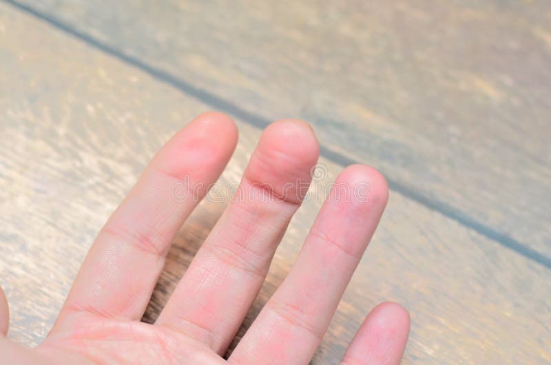 Dislocated Finger on Hand, Top View. Stock Image - Image of injury ...