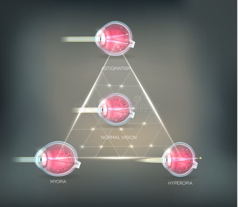 Disturbi della vista illustrazione vettoriale. Illustrazione di salute ...