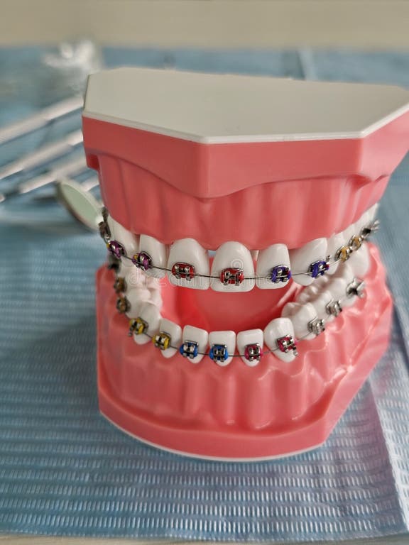 Display of Dental Braces on a Model Highlighting Different Color ...