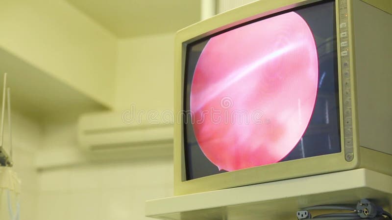 Display with Knee during Endoscopy Surgery in Stock Footage - Video of ...