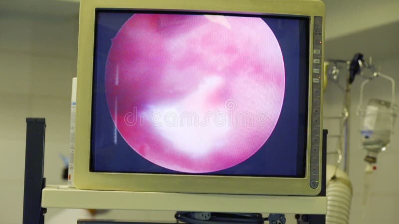 Display with Knee during Endoscopy Surgery - Stock Footage - Video of ...