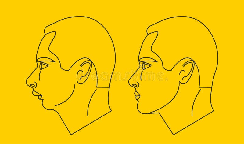 Distal Bite, Woman with Malocclusion Stock Vector - Illustration of ...