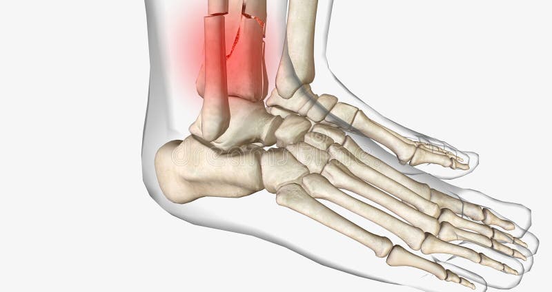 Distal Tibia Fractures Affect the Ankle Joint and Can Often Involve a ...