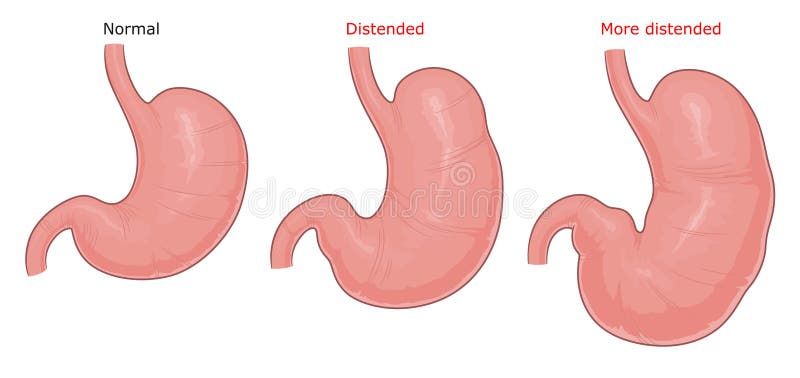 Distended Stomach, Abdominal Distension Line Icon. Stock Vector ...
