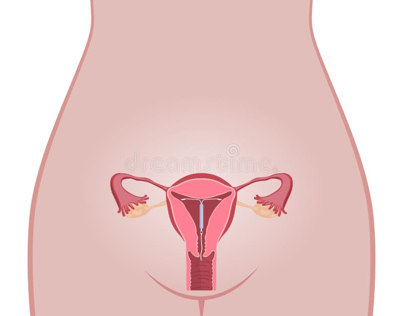 Icono De Doodle De Dispositivo Intrauterino Ilustración Vectorial