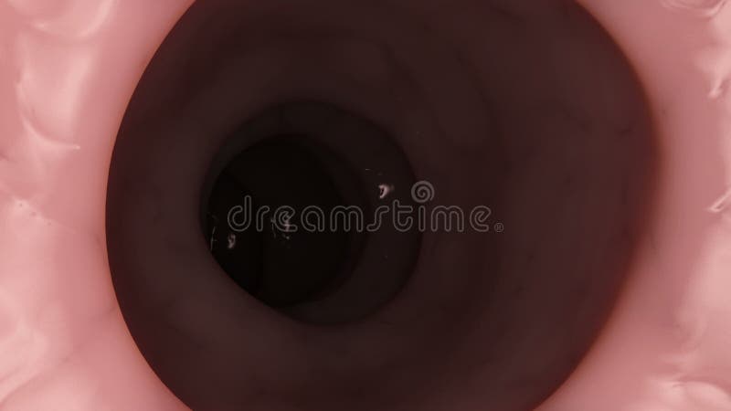 Diverticle from Inside the Colon Stock Footage - Video of ...