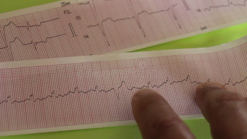 Doctor Analyzing an Electrocardiogram. Cardiac Arrhythmia Recorded in ...
