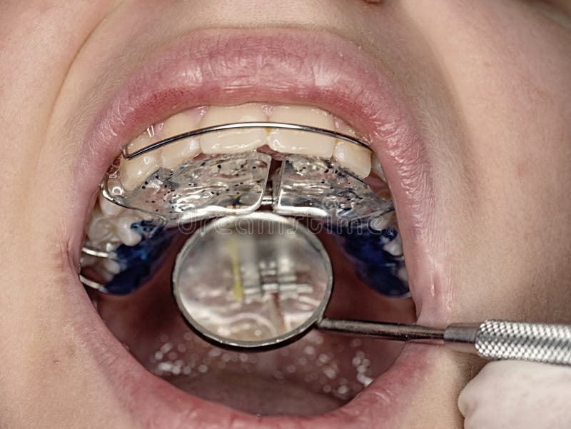 Doctor Check Teeth with Orthodontic Correction Stock Photo - Image of ...