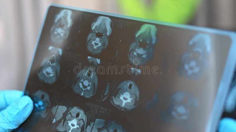 A Doctor Examines a Computed Tomography Scan of the Thyroid Gland on a ...