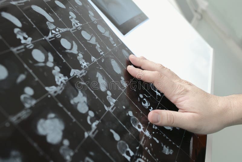 Doctor Examining CT Scan Image on the Light Box Stock Photo - Image of ...