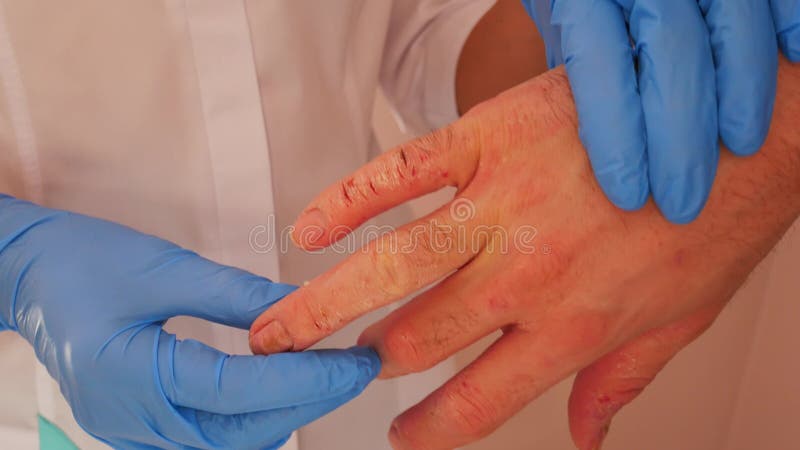 Dermatitis Hands Palm Skin Itchy Scratches on Dry Skin Female Hands ...