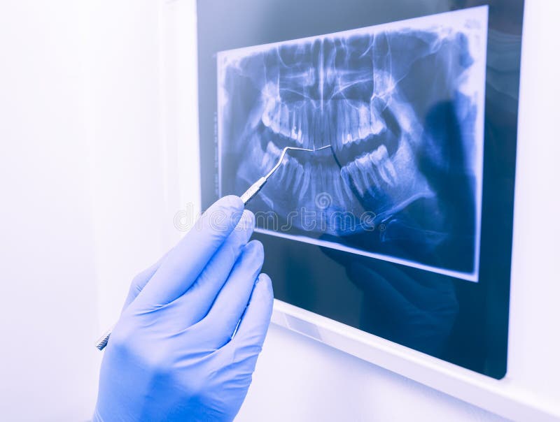 Doctor Explaining Dental Xray Stock Image - Image of people, hygiene ...