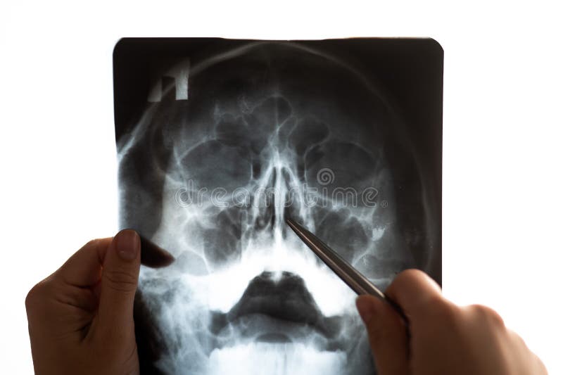 The Doctor Looks at the X-ray of the Sinuses. Stock Image - Image of ...