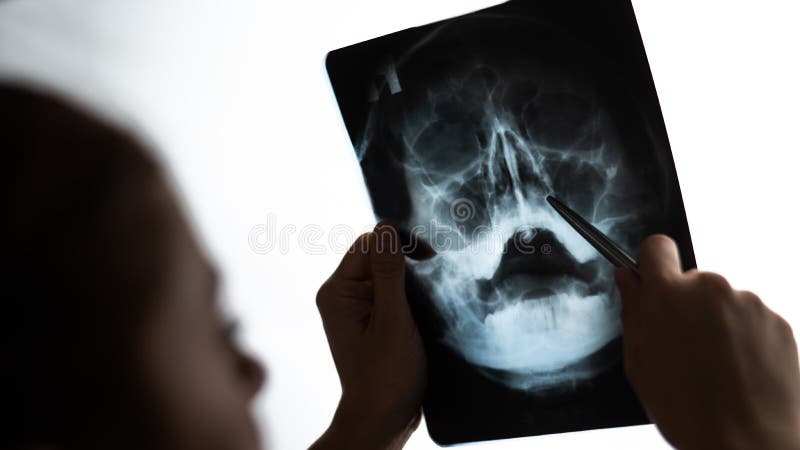 The Doctor Looks at the X-ray of the Sinuses. Stock Image - Image of ...