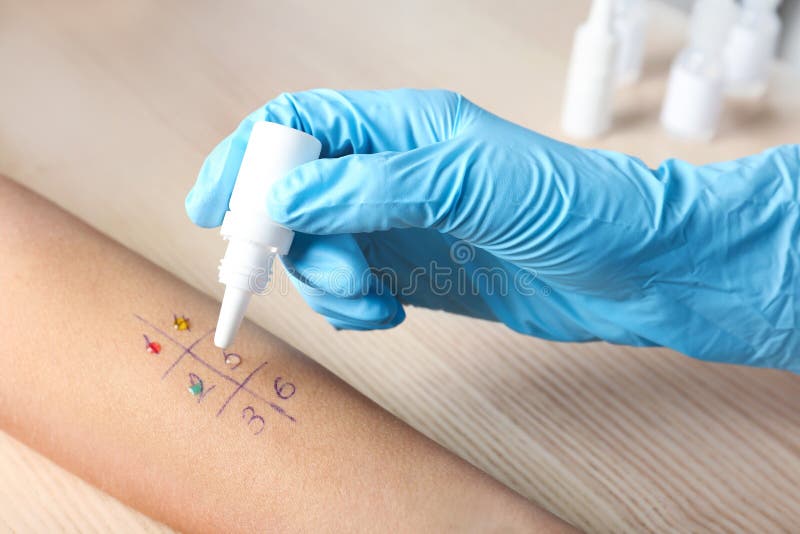 Doctor Making Allergy Test at Table Stock Image - Image of exam ...