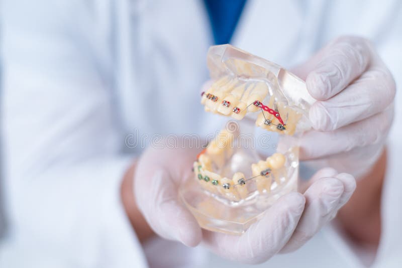 Doctor Orthodontist Shows How the System of Braces on Teeth is Arranged ...
