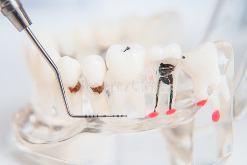 Doctor Orthodontist Shows the Instrument on Caries in the Teeth Stock ...