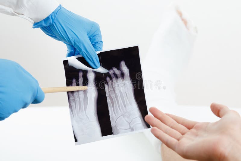 Doctor Showing Patient X-ray Image of a Broken Finger Leg in Plaster ...