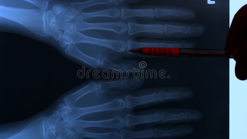 Doctor Studying X-ray Plate of the Bones of the Both Human Hands Stock ...