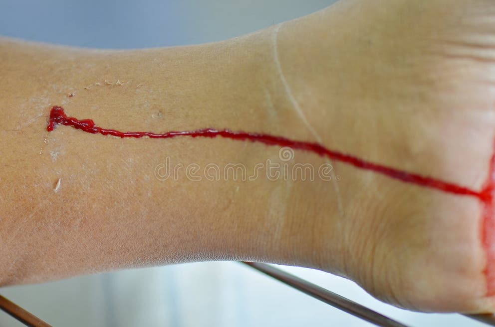 Dog bite wound. stock photo. Image of painful, puncture - 82480872