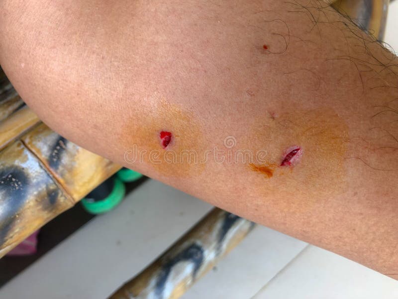 Dog bite leg stock image. Image of bites, bite, outside - 110626057