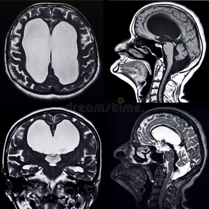 Dolor De Cabeza, Cerebro MRI Foto de archivo - Imagen de aislado ...