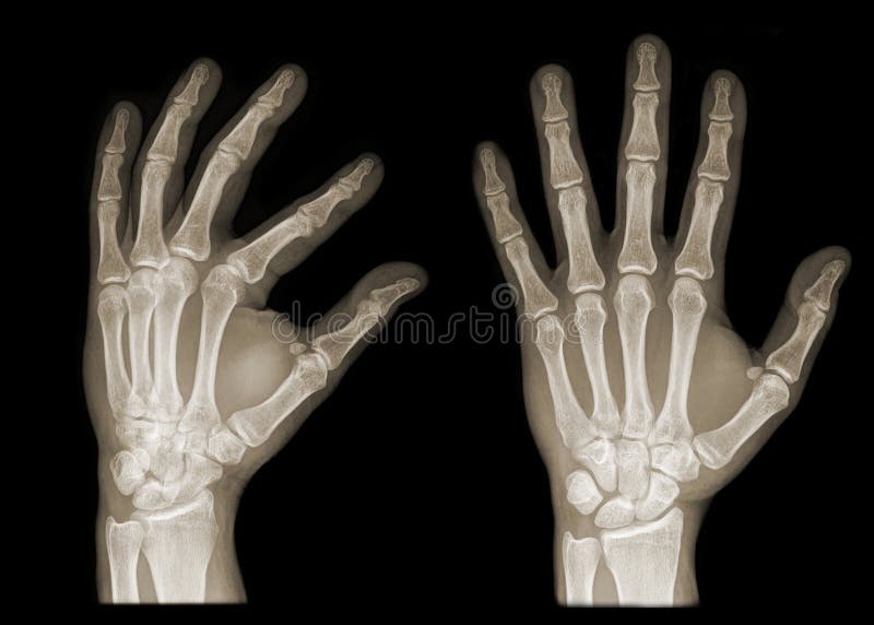 Radiografía del dedo imagen de archivo. Imagen de artritis - 14031903