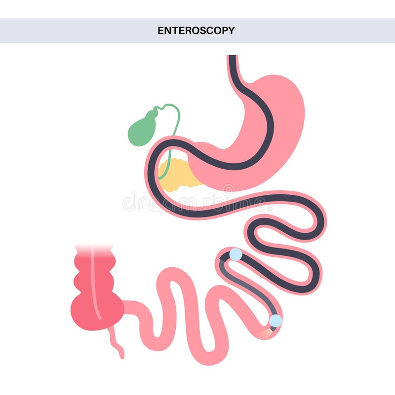 Double balloon enteroscopy stock vector. Illustration of inflated ...