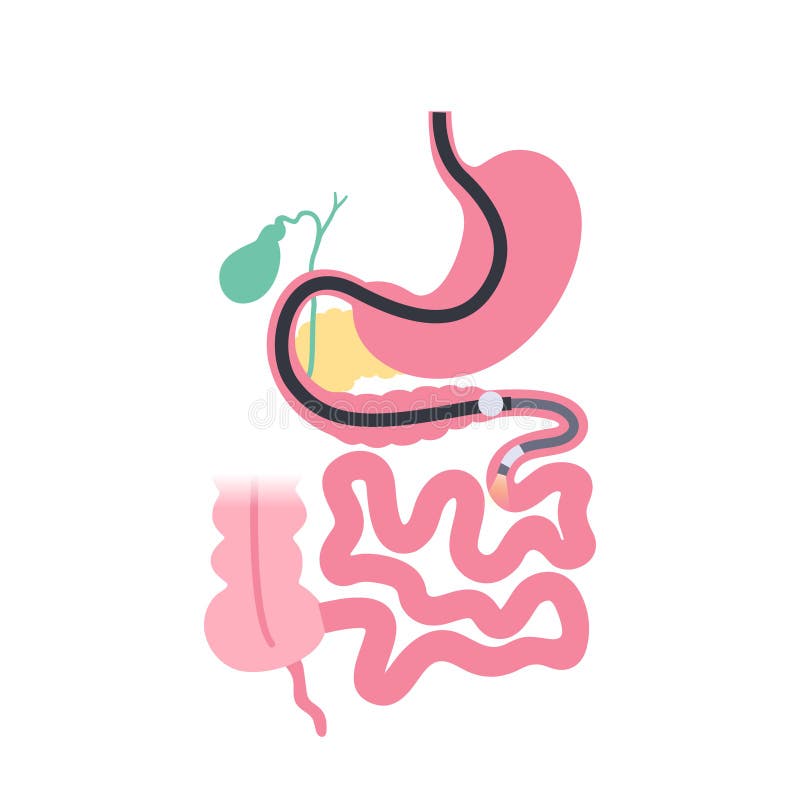 Double balloon enteroscopy stock vector. Illustration of bowel - 289283653