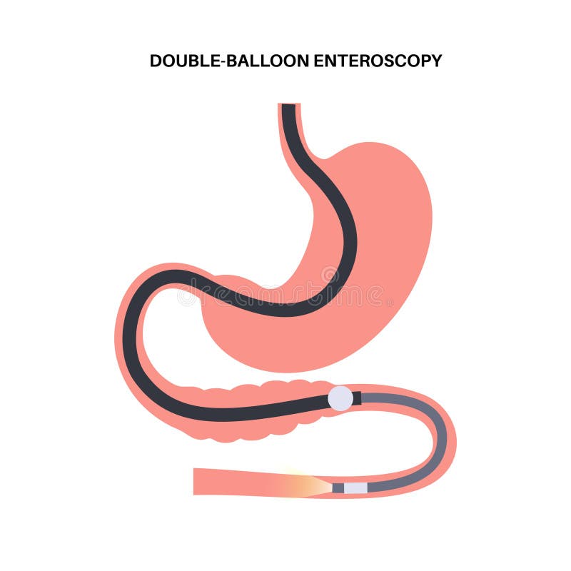 Double balloon enteroscopy stock vector. Illustration of treatment ...