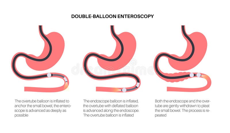 Double balloon enteroscopy stock vector. Illustration of treatment ...