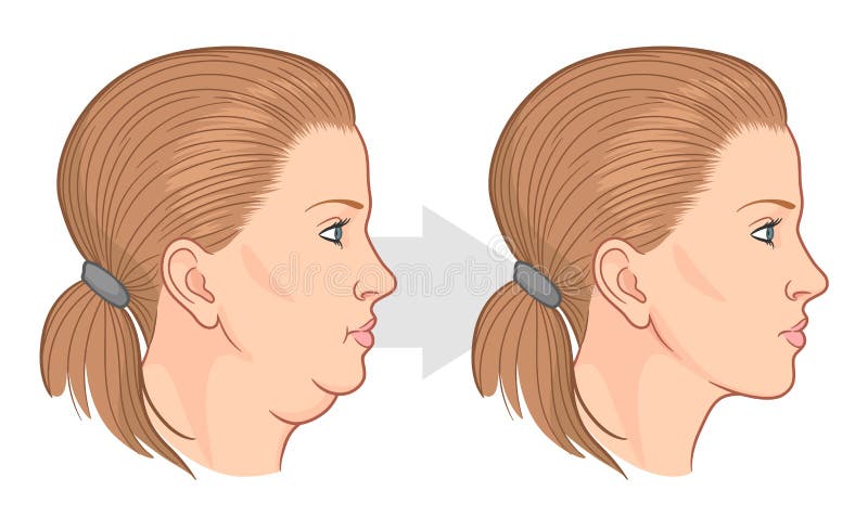 Double chin fat loss stock vector. Illustration of beauty - 200497611