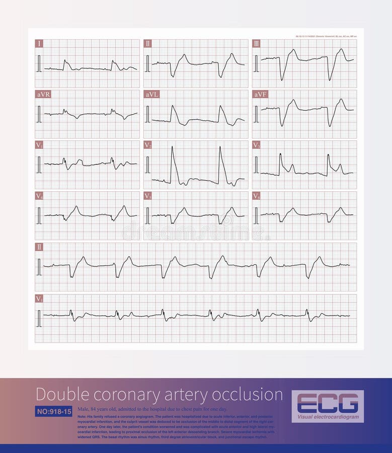 Double Coronary Artery Occlusion Stock Image - Image of fibrillation ...