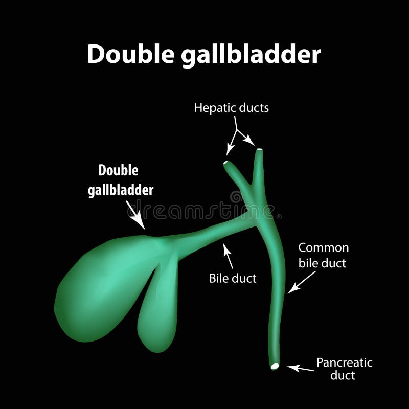 Infundibulum Gallbladder