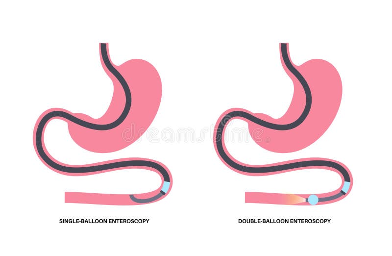 Double balloon enteroscopy stock illustration. Illustration of ...