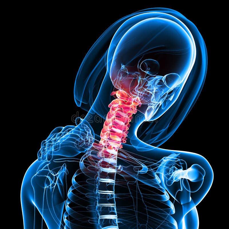 Douleur cervicale femelle illustration stock. Illustration du ...