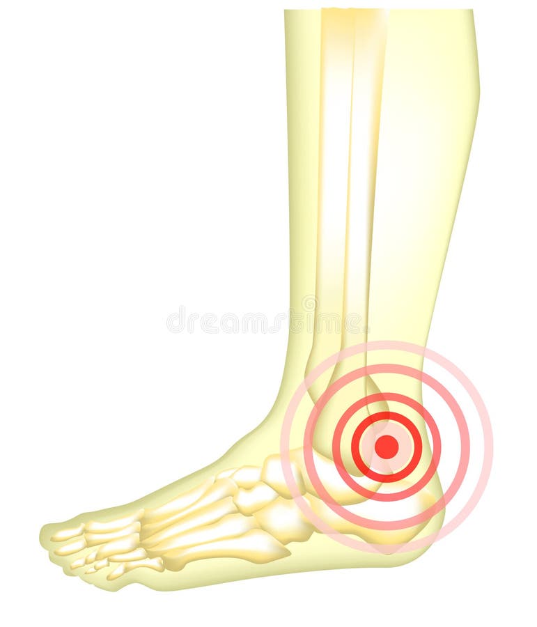 Douleur de jambes illustration de vecteur. Illustration du inflammation ...