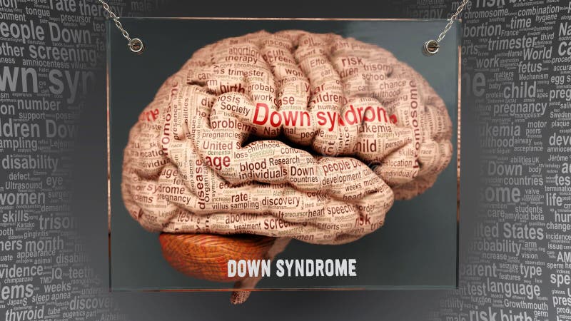 Down Syndrome in Human Brain Stock Illustration - Illustration of ...