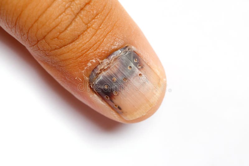 Drenagem Subungual Dos Hematomas Imagem de Stock - Imagem de dedo ...