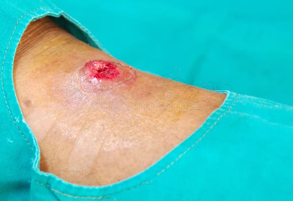 Dressing wound abscess stock photo. Image of closeup - 50514926
