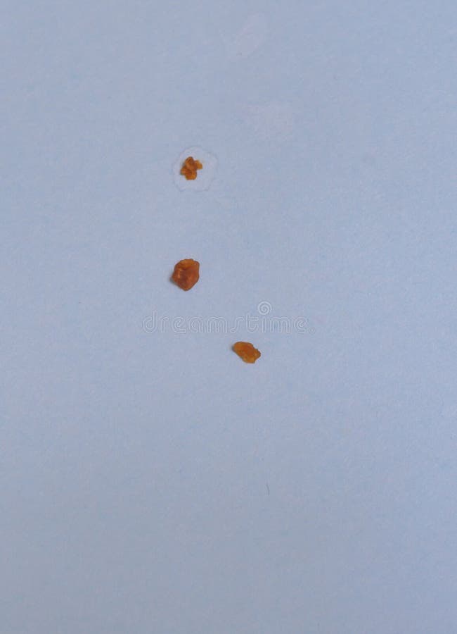 Dried Tonsil Stone Tonsillolith Stock Image - Image of educational ...