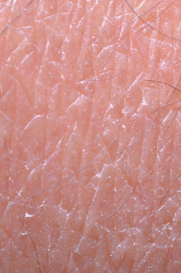 Droge huid stock afbeelding. Image of vlek, teint, menselijk - 34808005