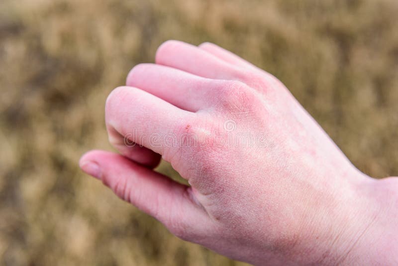 Dry, chapped skin on hand. stock photo. Image of body - 176536276