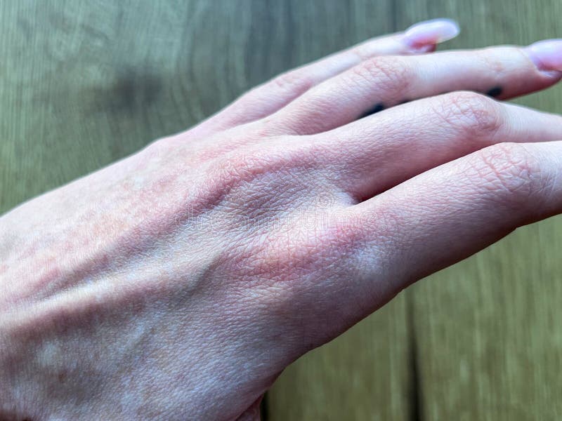 Dry Cracked Cold Skin on Hand Stock Image - Image of hand, skin: 341881071